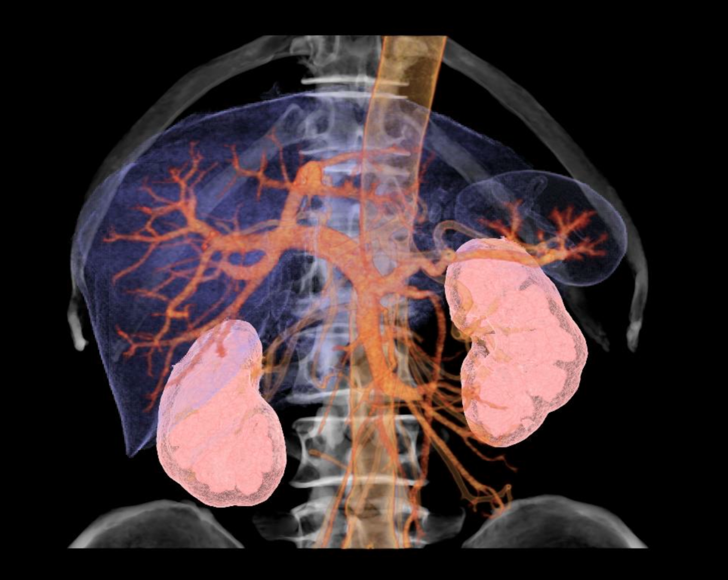 Liver Segmentation Package | TeraRecon