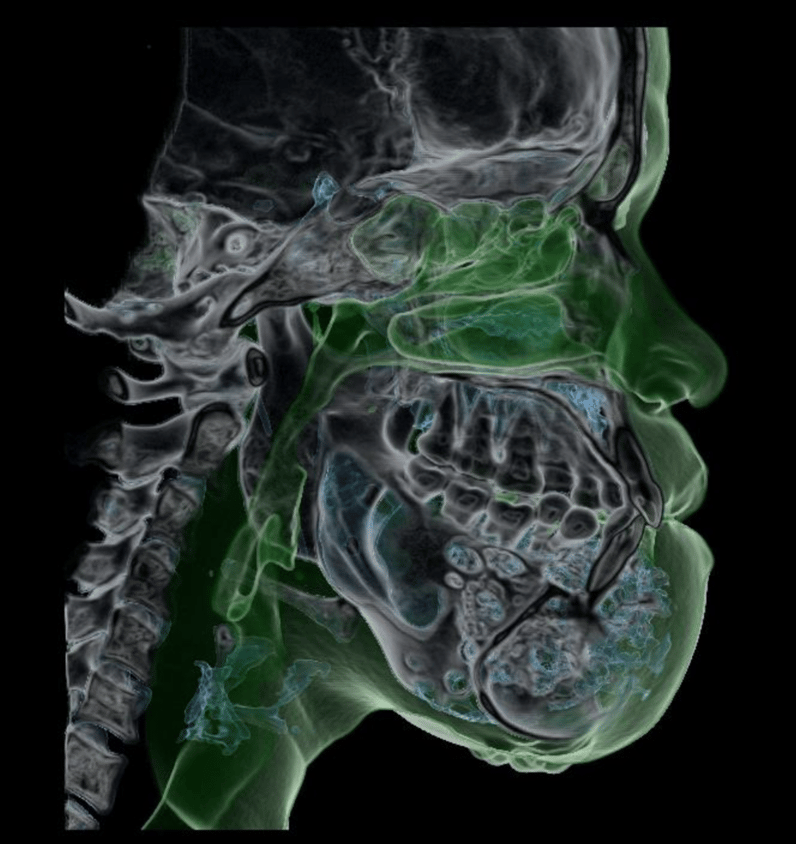 Maxillo-Facial Package | TeraRecon