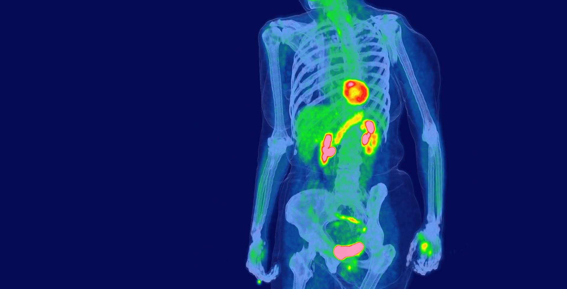 Body Fusion Package | TeraRecon