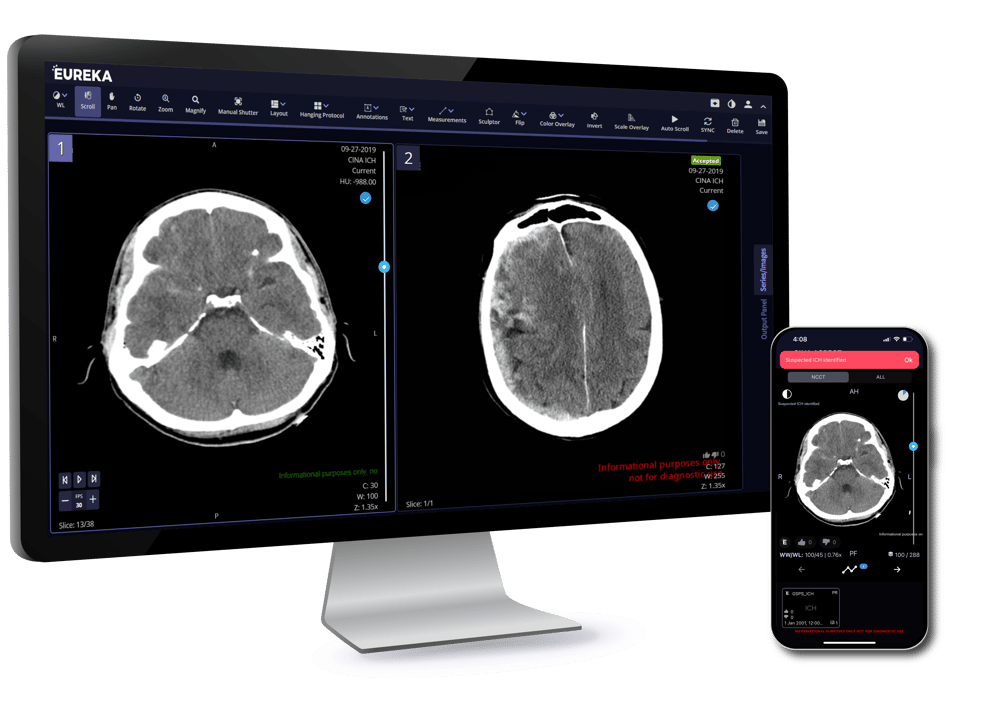 TeraRecon Neuro | AI-insight driven decision support for neurovascular ...