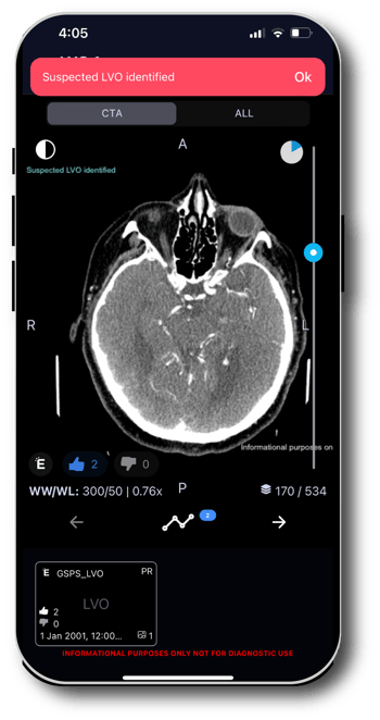 TeraRecon Neuro | AI-insight driven decision support for neurovascular ...