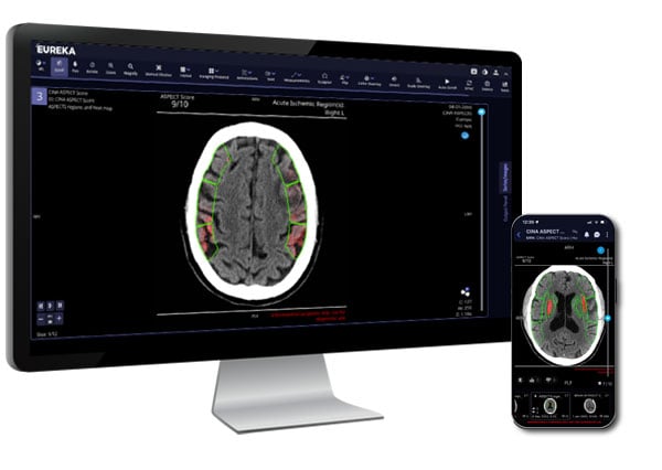 TeraRecon Neuro | AI-insight driven decision support for neurovascular ...