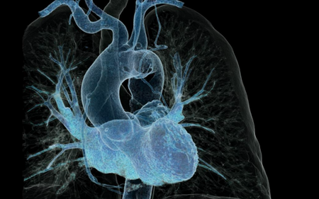 CT Cardiac Advanced Visualization Package | Terarecon