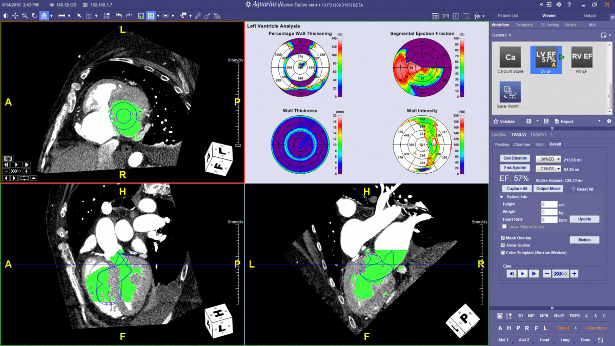 TeraRecon Advanced Visualization Capabilities