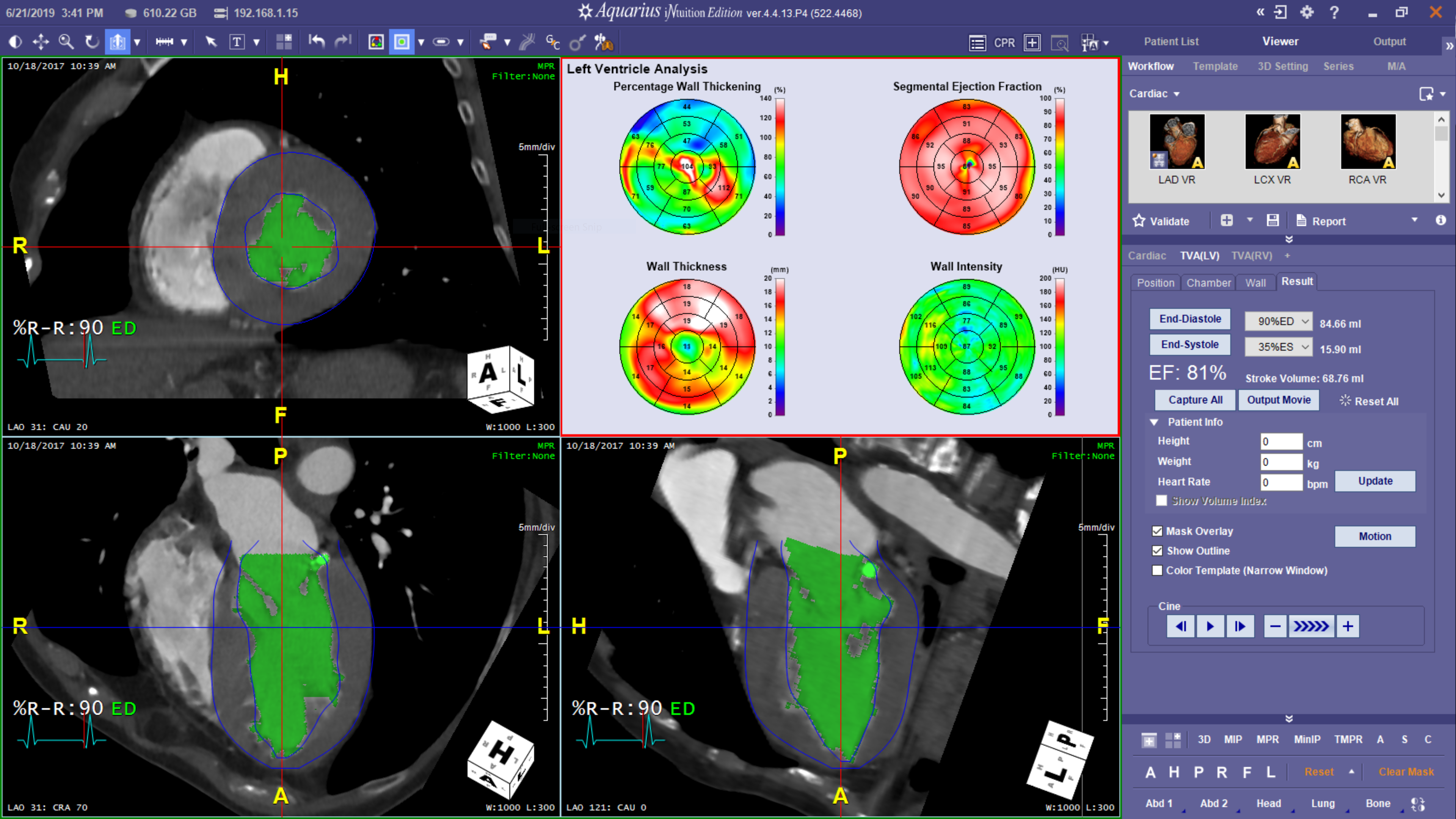 CT Body Advanced Visualization Package | Terarecon