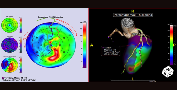 CT Cardiac Advanced Visualization Package | Terarecon