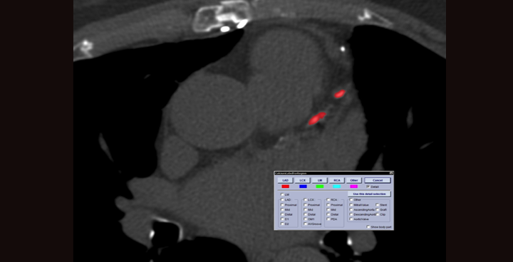 CT Cardiac Advanced Visualization Package | Terarecon