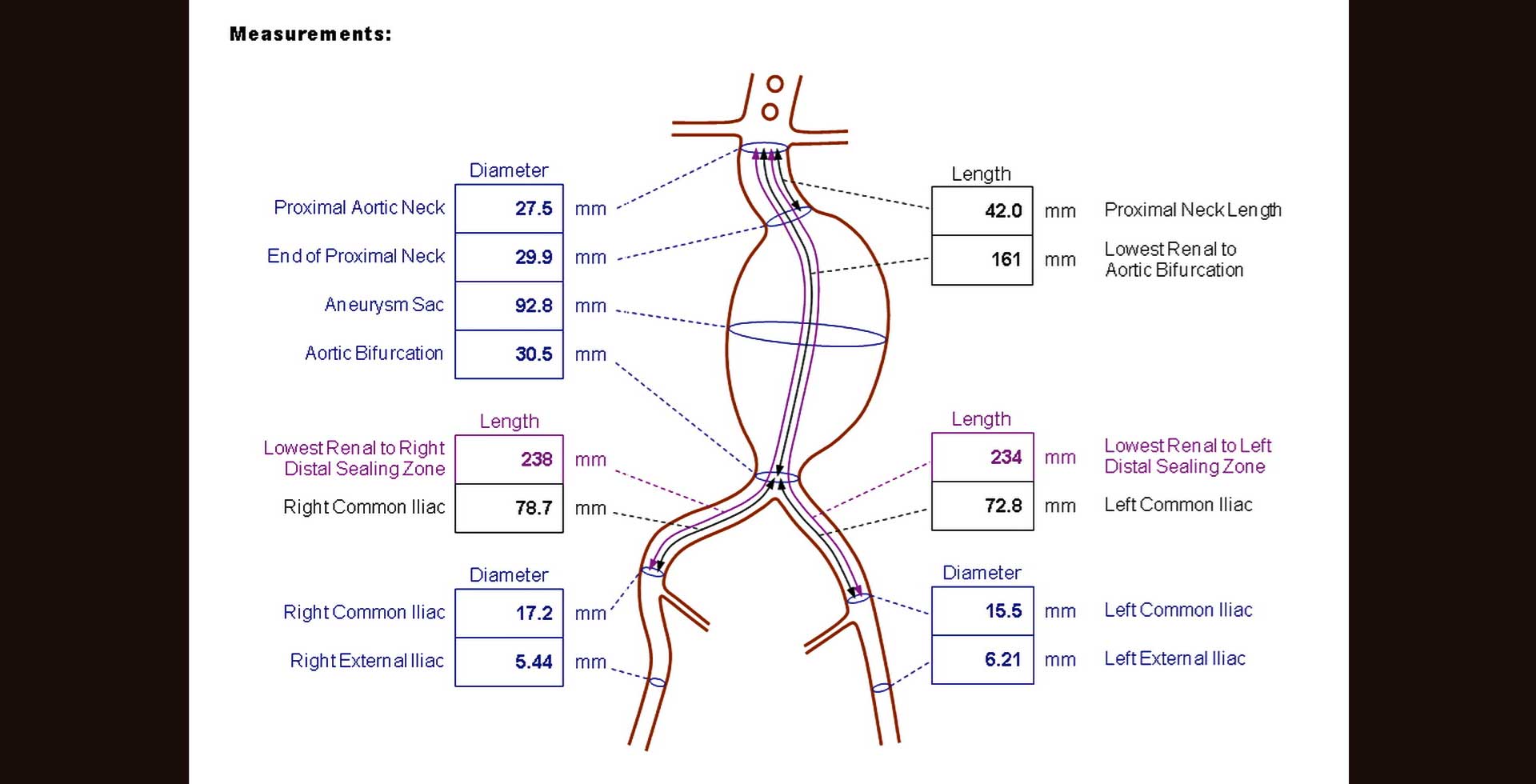 EVAR Planning Clinical Package | Terarecon