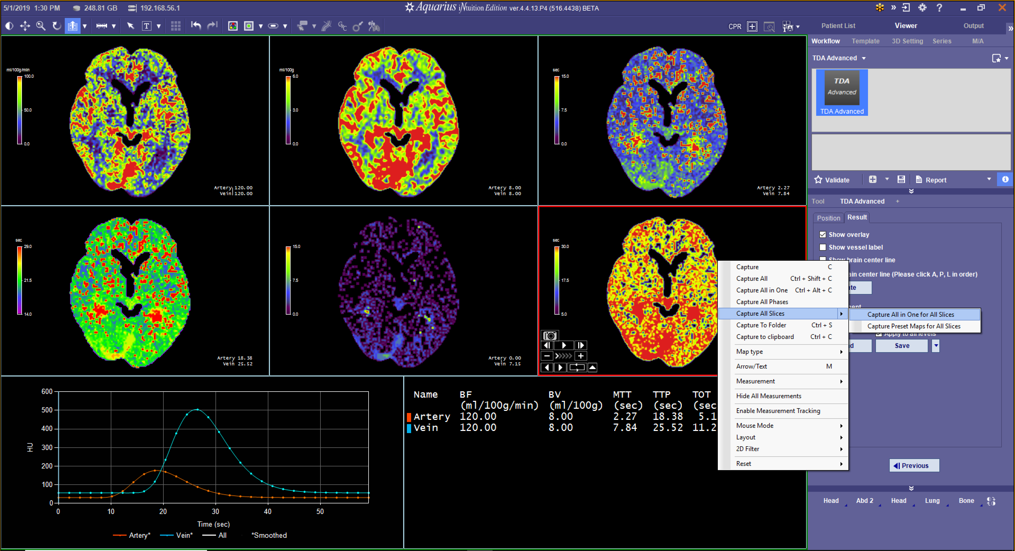Brain Perfusion TDA - Advanced Tour | TeraRecon Advanced Visualization