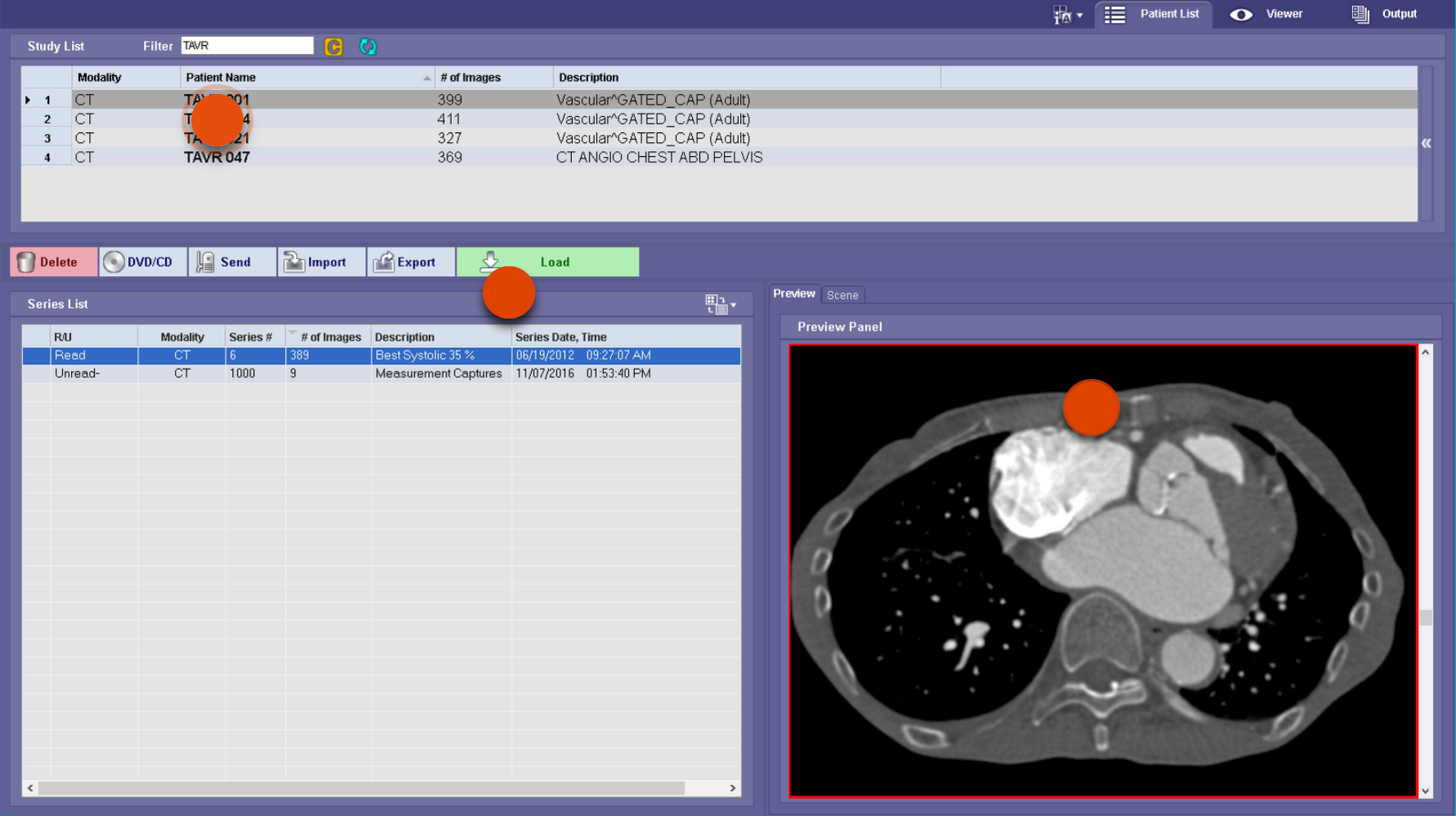 TAVR Planning Clinical Package | Terarecon