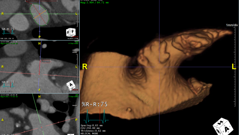 CT Cardiac Advanced Visualization Package | Terarecon